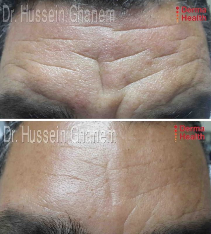 Botox for Forehead Lines and Wrinkles – DermaHealth