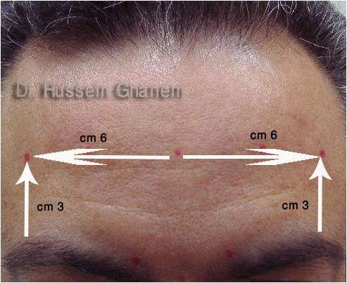 Geometric Wrinkle Injections – DermaHealth