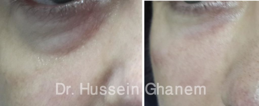 Eye Wrinkles and Tear Trough Treatments – DermaHealth