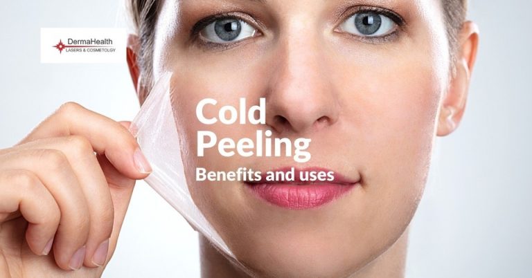Restore Your Skin with A Cold Skin Peeling Session – DermaHealth