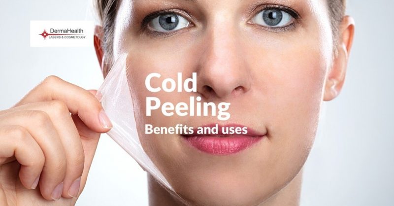 Restore Your Skin with A Cold Skin Peeling Session – DermaHealth
