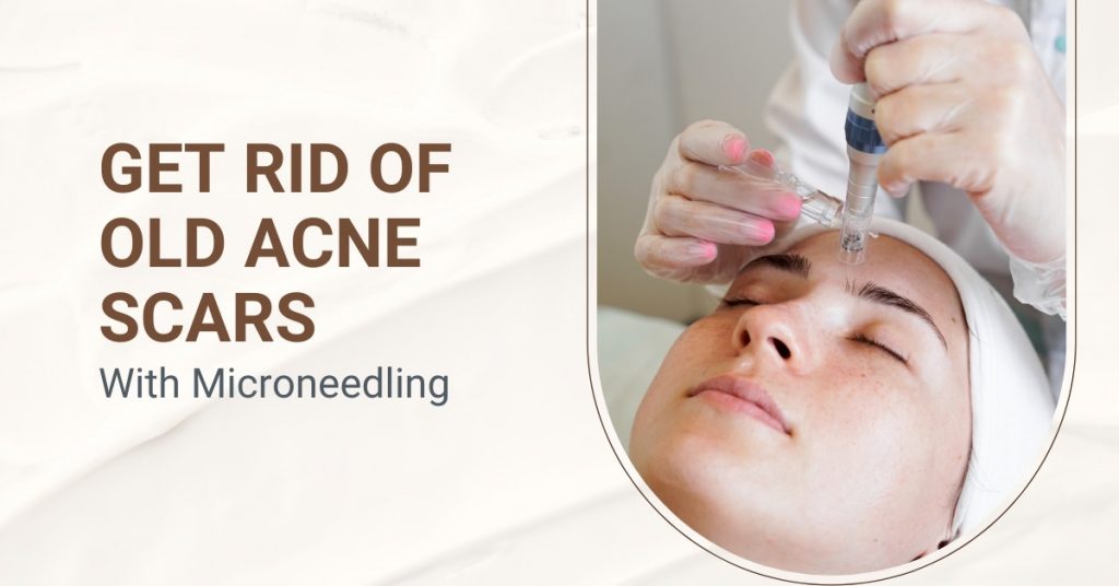Improving Acne Scars with Microneedling – DermaHealth