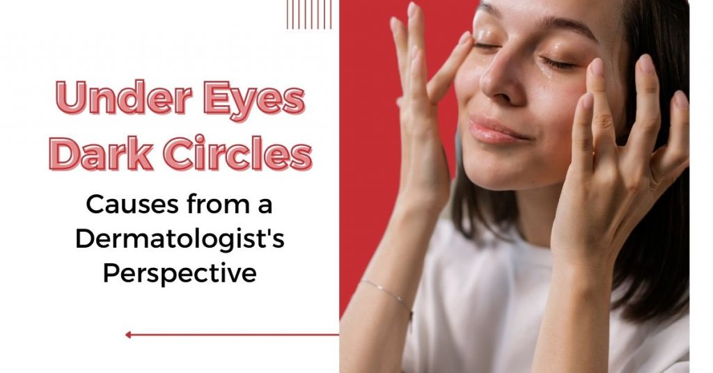Dark Circles Under Eyes Causes From A Dermatologist S Perspective